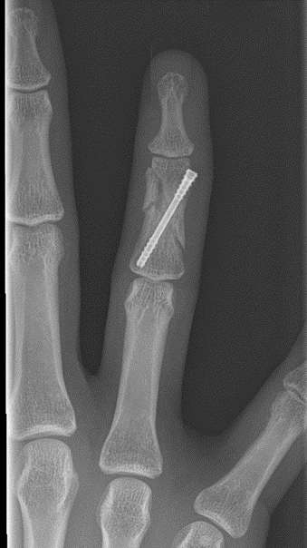 NX Nail for fixation of a comminuted middle P2 phalanx fracture.