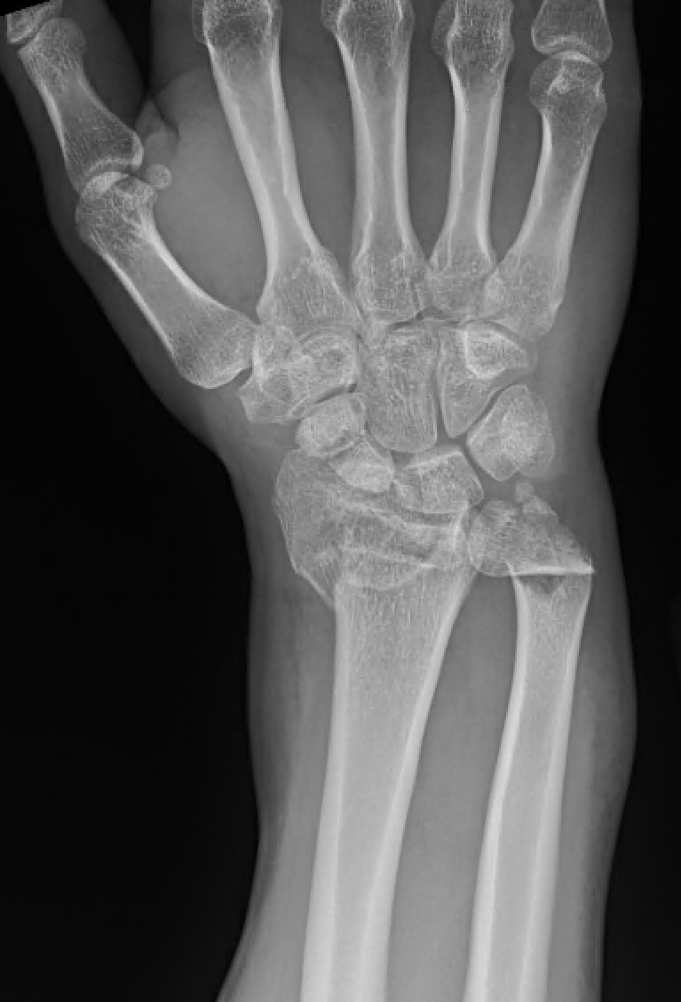 NX Nail fixation of distal ulna fracture in high energy wrist injury.