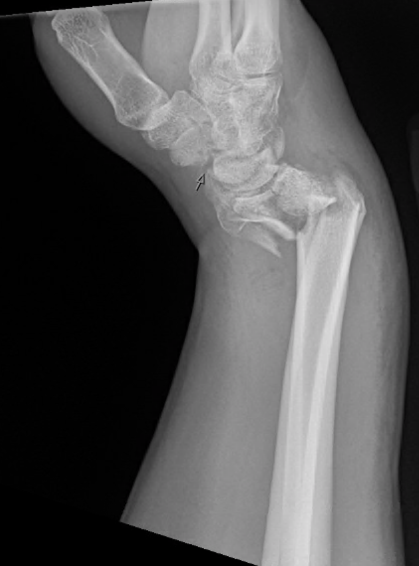 NX Nail fixation of distal ulna fracture in high energy wrist injury.