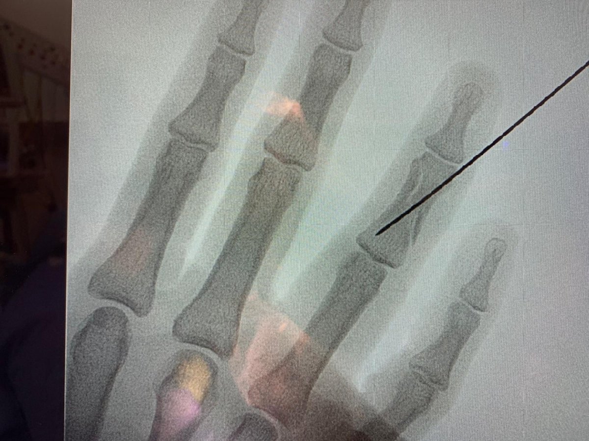 NX Nail for fixation of a comminuted middle P2 phalanx fracture.