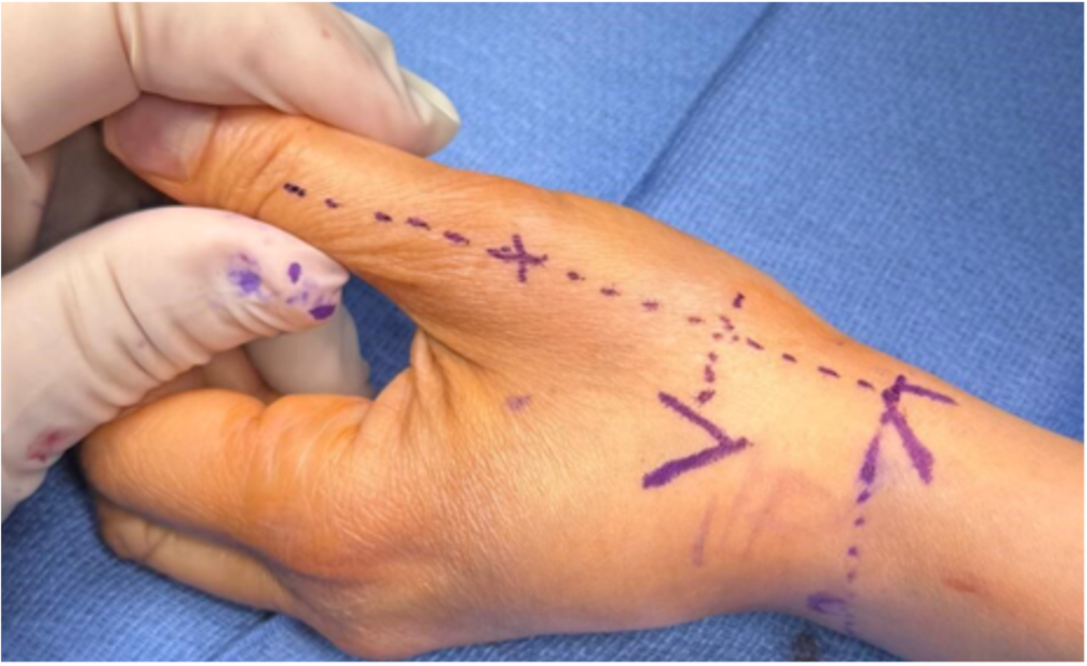 Modified Approach to Griplasty™ CMC Suspensionplasty: Technical Note ...