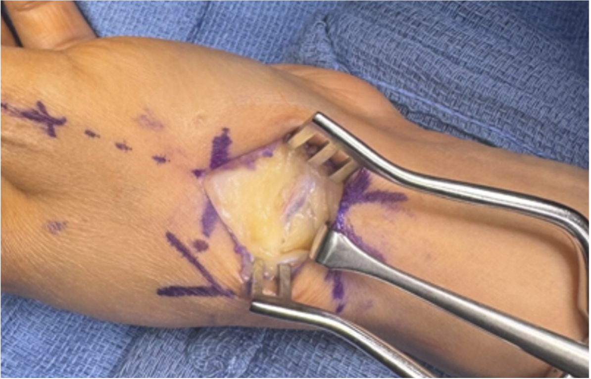 Modified Approach to Griplasty™ CMC Suspensionplasty: Technical Note ...