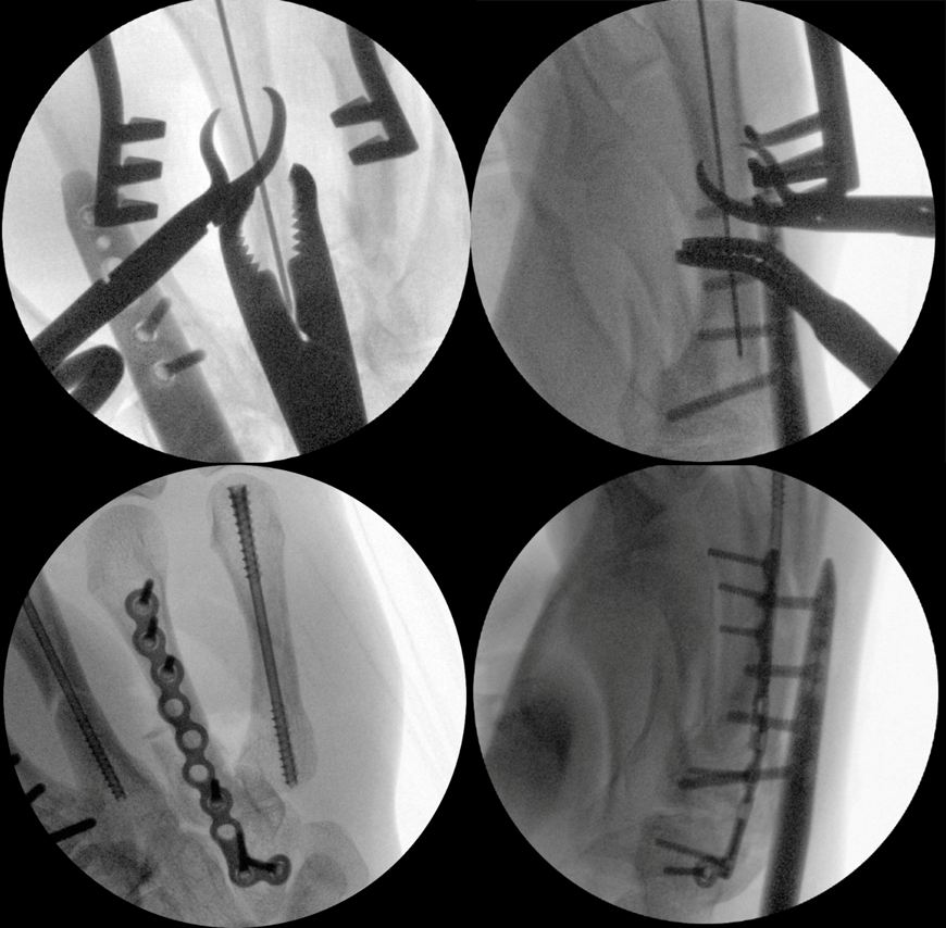 The use of NX Nail for fixation of multiple metacarpal fractures ...