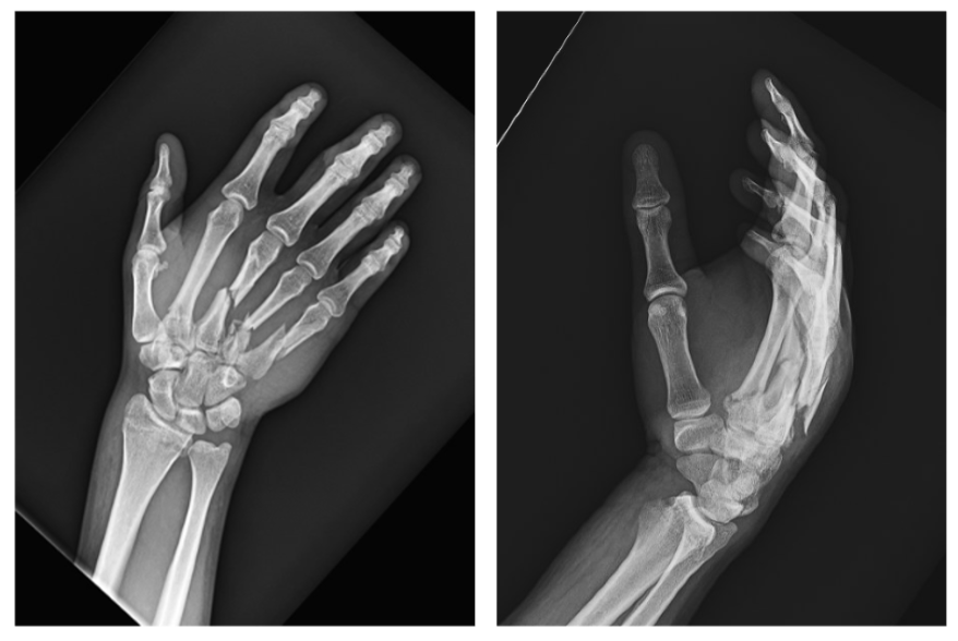 The use of NX Nail for fixation of multiple metacarpal fractures ...