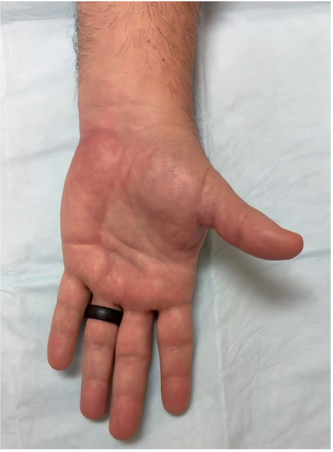 The Use of Griplasty™ System for the Treatment of Thumb Carpometacarpal ...