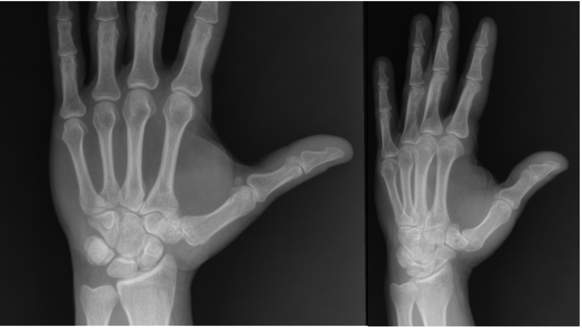 The Use of Griplasty™ System for the Treatment of Thumb Carpometacarpal ...