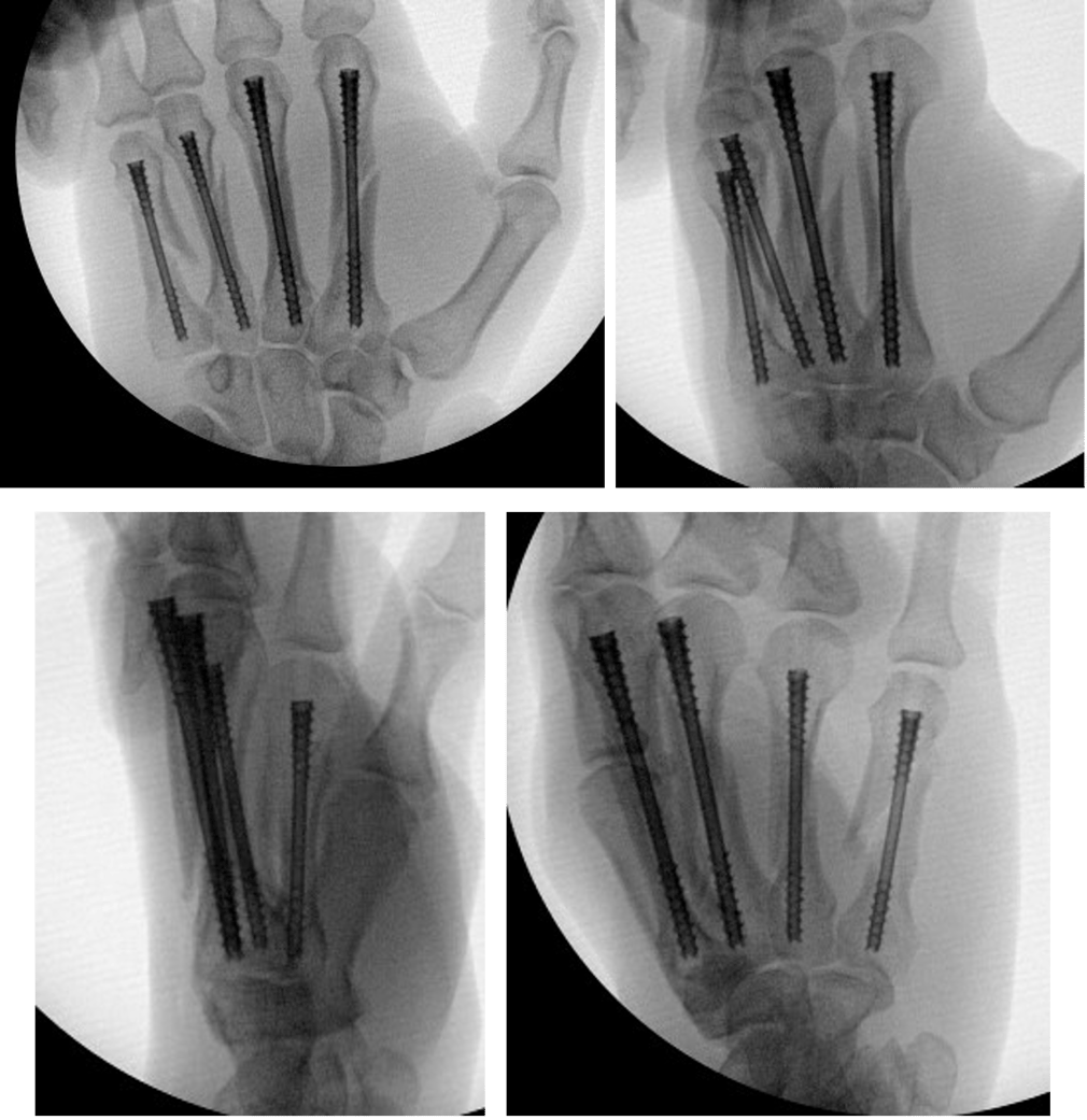 Use of the NX Nail for percutaneous reduction and internal fixation of ...