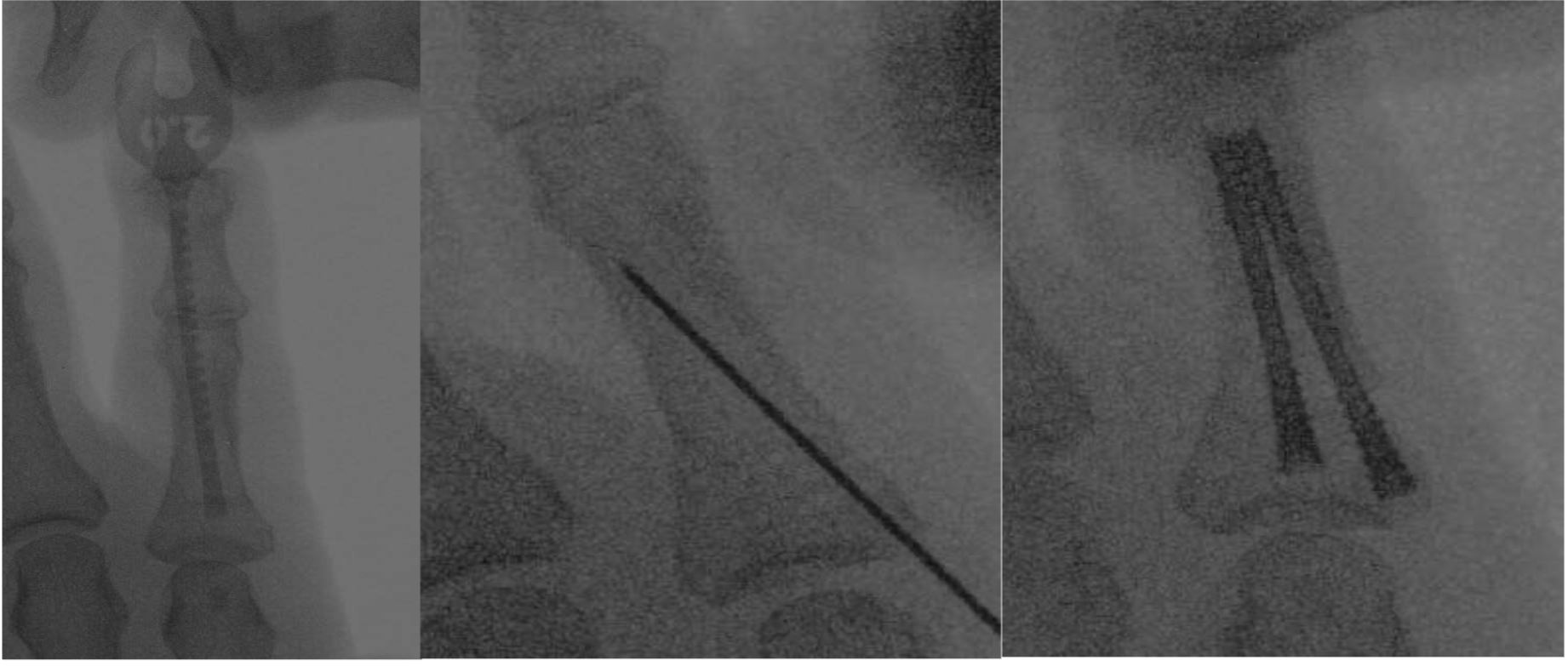 Use of the NX Nail Fixation of Angulated P1 Base Fracture