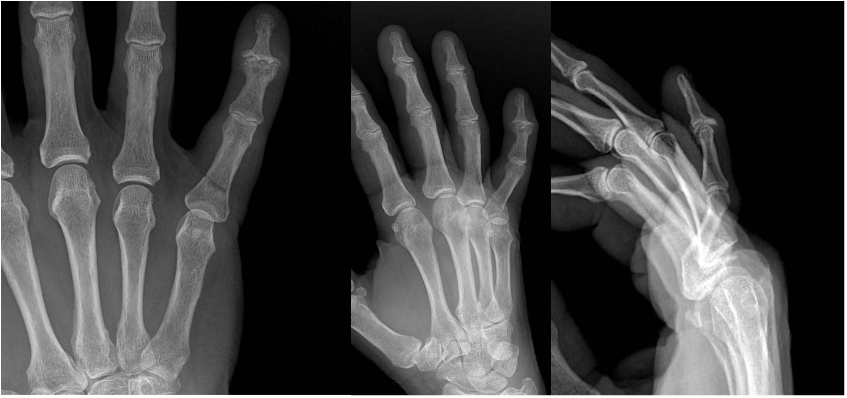 Use of the NX Nail Fixation of Angulated P1 Base Fracture