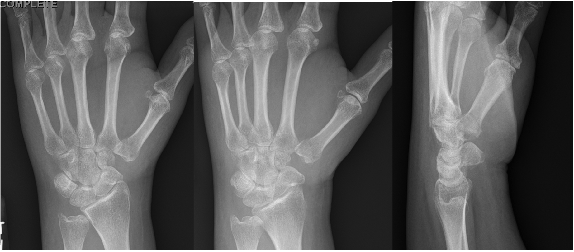 Use of Griplasty™ in the surgical management of carpometacarpal thumb ...