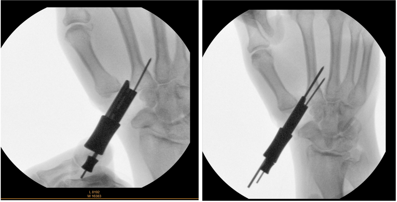 Use of Griplasty™ in the surgical management of carpometacarpal thumb ...