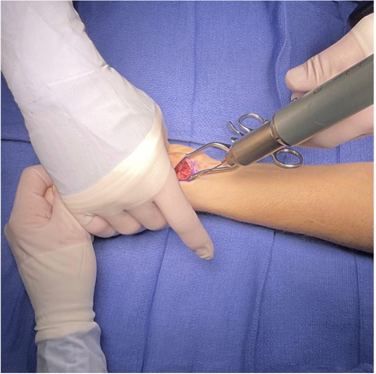 Use of Griplasty™ in the Revision Surgical Management of ...
