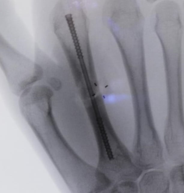 NX Nail fixation of fifth metacarpal fracture involving distal ...