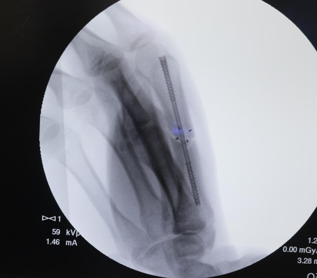 Use of NX Nail for oblique fracture fixation of 2nd metacarpal