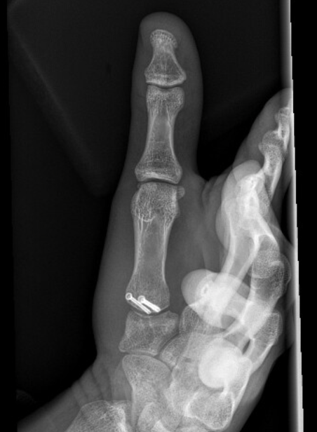 Micro Screw for management of Bennett’s Fracture of the thumb.