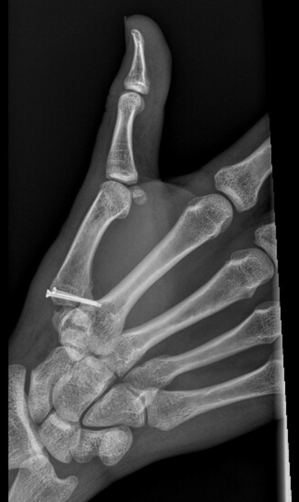 Micro Screw for management of Bennett’s Fracture of the thumb.