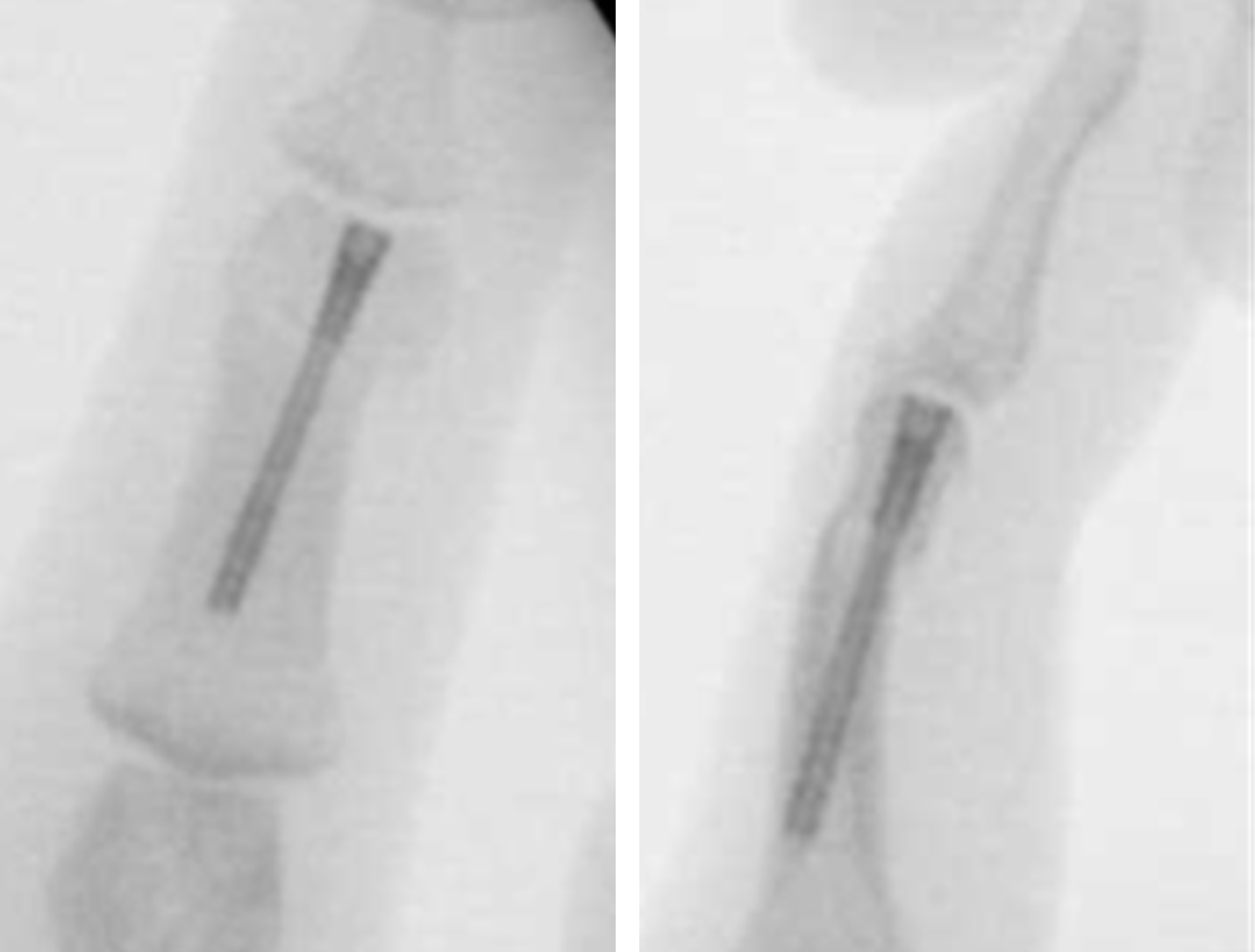 NX Nail fixation of a displaced head of P2 phalanx fracture.
