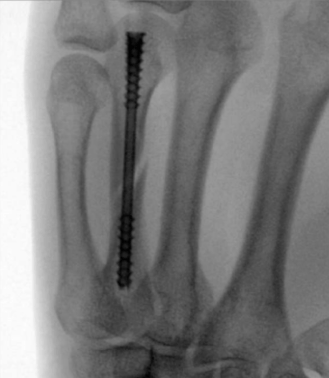 NX Nail for fixation of spiral fracture of fourth metacarpal.