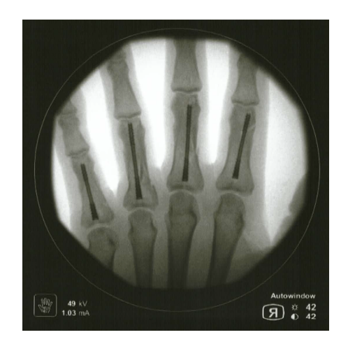 Use of the NX Nail for intramedullary fixation of 2nd-5th proximal ...
