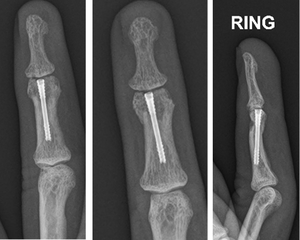 NX Nail fixation of a displaced head of P2 phalanx fracture.