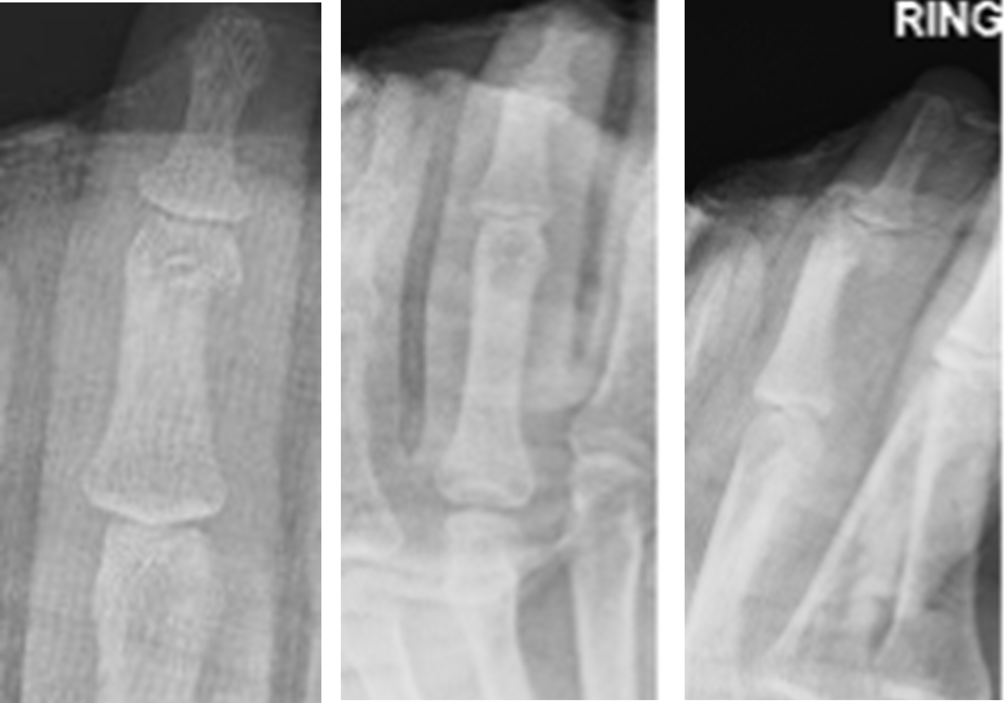 NX Nail fixation of a displaced head of P2 phalanx fracture.