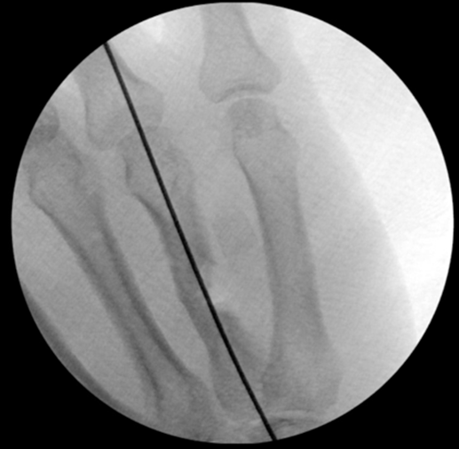 NX Nail fixation of 4th Metcarpal. ORIF for correction of malunion