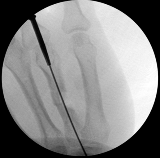 NX Nail fixation of 4th Metcarpal. ORIF for correction of malunion