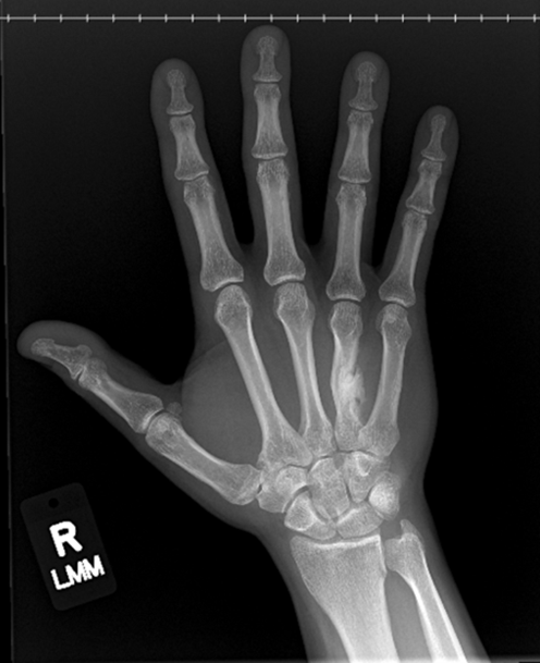 NX Nail fixation of 4th Metcarpal. ORIF for correction of malunion