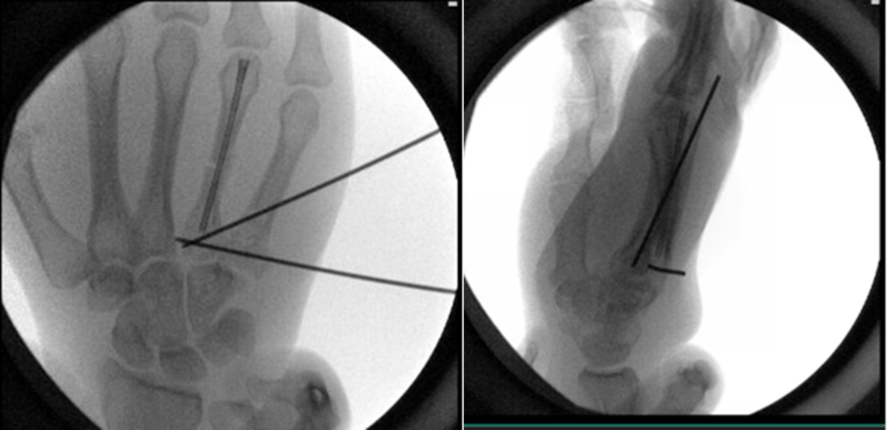 The use of the NX Nail for fixation of a transverse fourth metacarpal ...