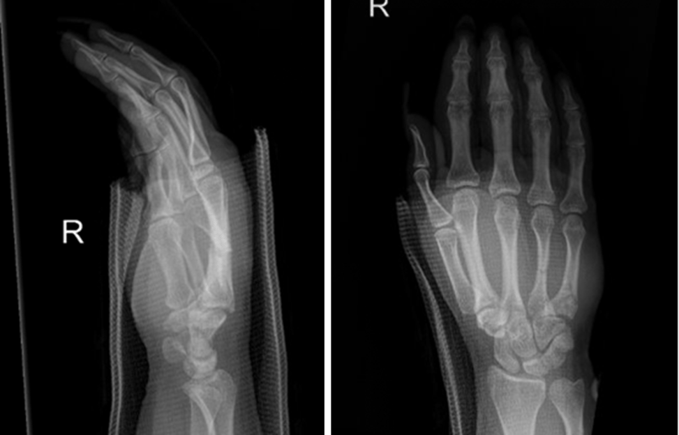 The use of the NX Nail for fixation of a transverse fourth metacarpal ...