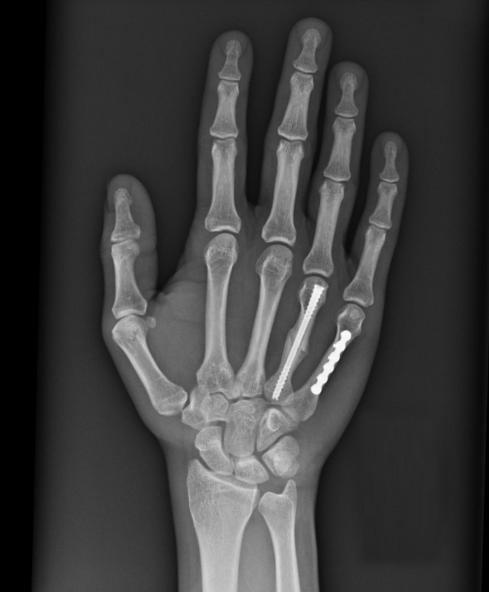 NX Nail for fixation of displaced 4th metacarpal shaft fracture.