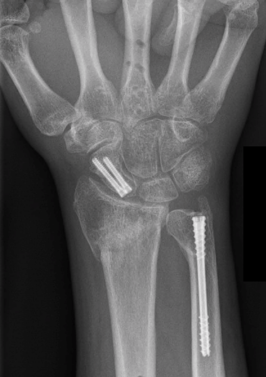 NX Nail fixation of distal ulna fracture in high energy wrist injury.