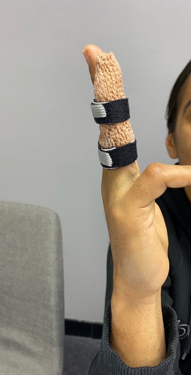 NX Nail for fixation of a comminuted middle P2 phalanx fracture.