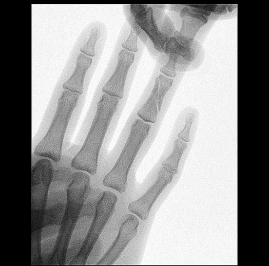 NX Nail for fixation of a comminuted middle P2 phalanx fracture.