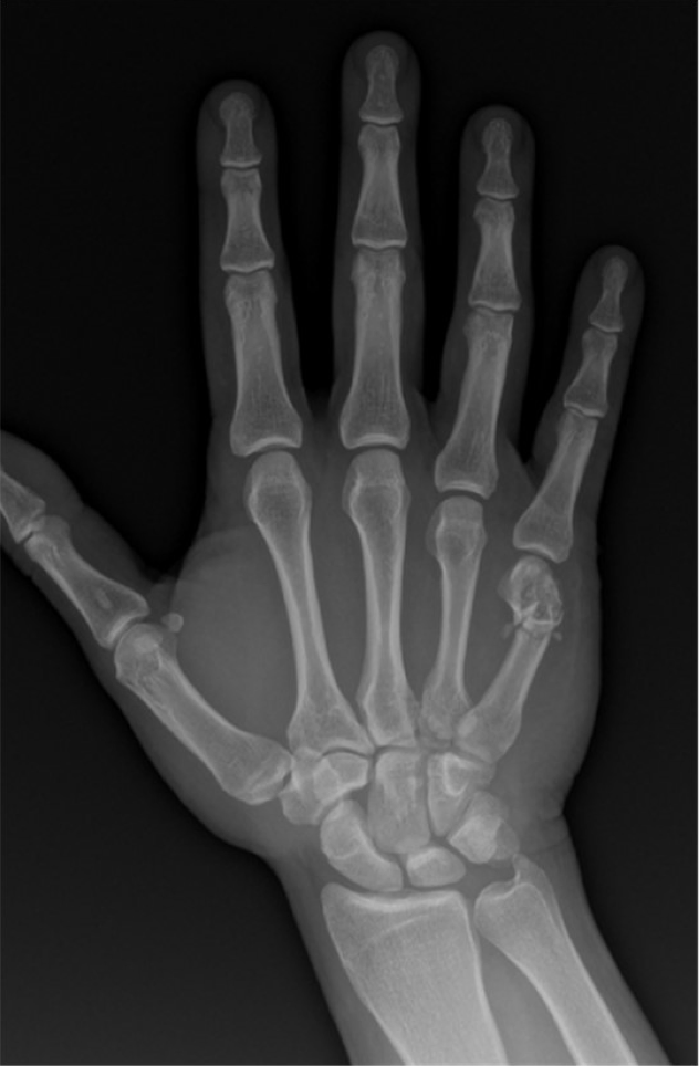NX Nail fixation of fifth metacarpal fracture involving distal ...