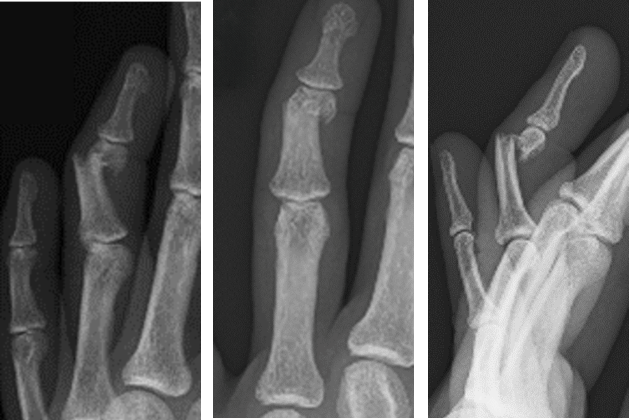 NX Nail fixation of a displaced head of P2 phalanx fracture.