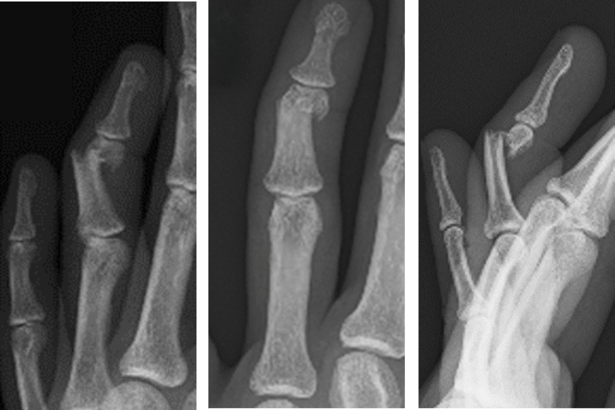 NX Nail fixation of a displaced head of P2 phalanx fracture.