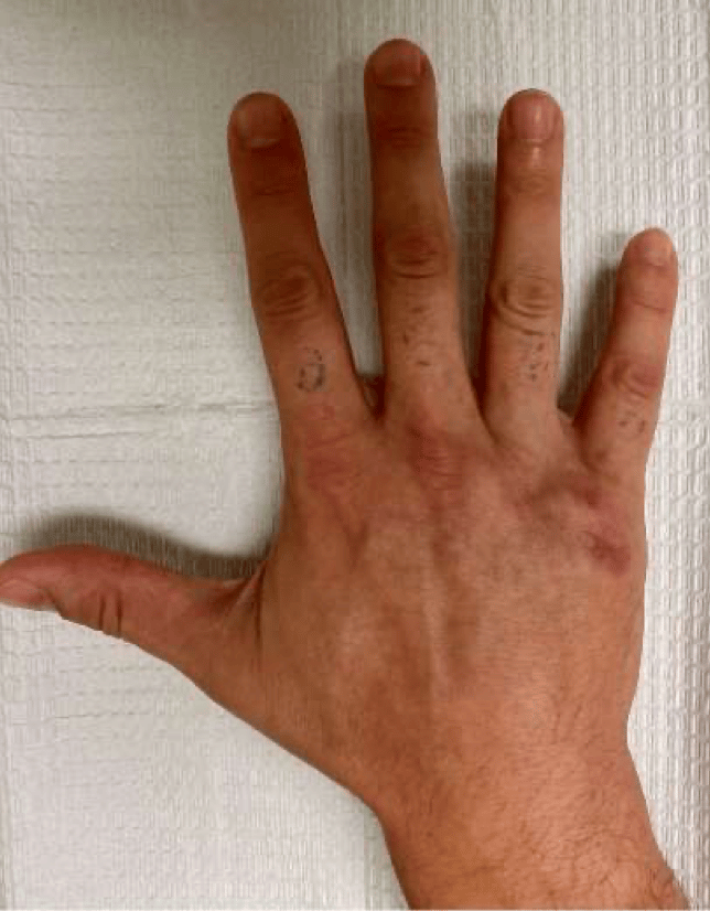 NX Nail fixation of fifth metacarpal fracture involving distal ...