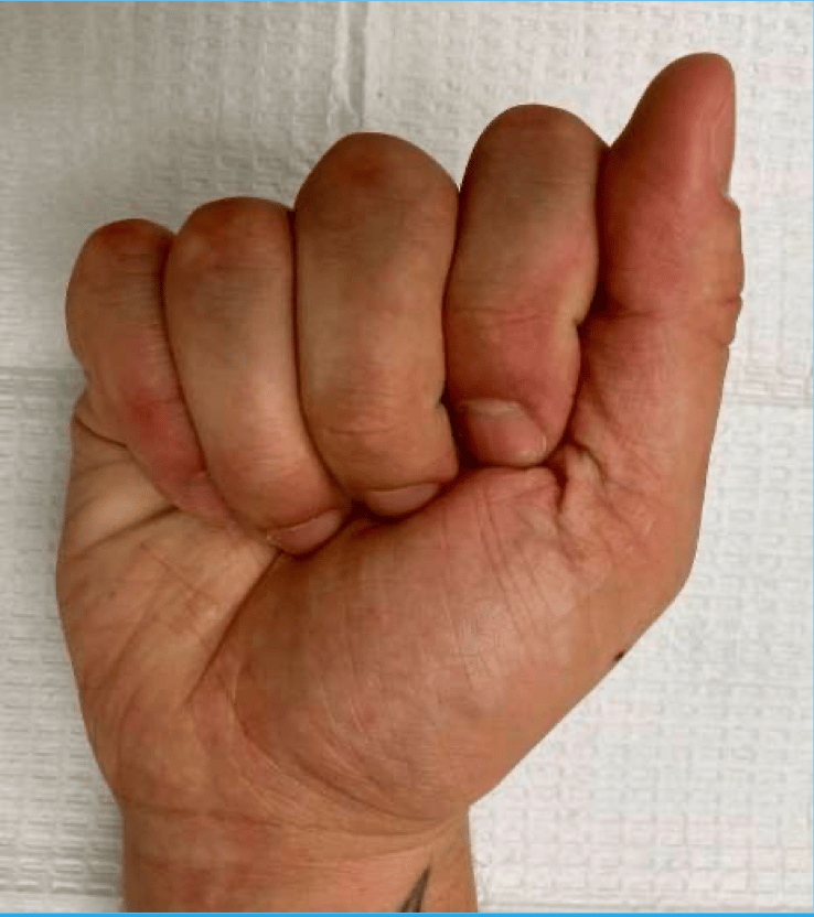 NX Nail fixation of fifth metacarpal fracture involving distal ...