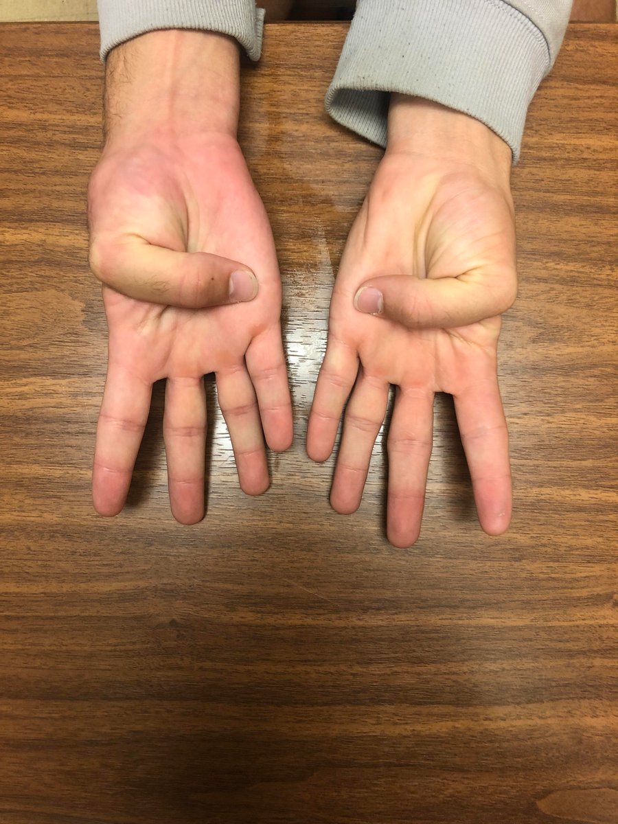 Micro Screw for management of Bennett’s Fracture of the thumb.
