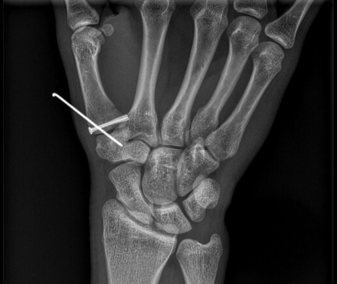 Micro Screw for management of Bennett’s Fracture of the thumb.
