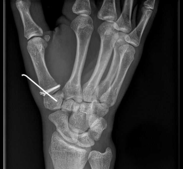 Micro Screw for management of Bennett’s Fracture of the thumb.