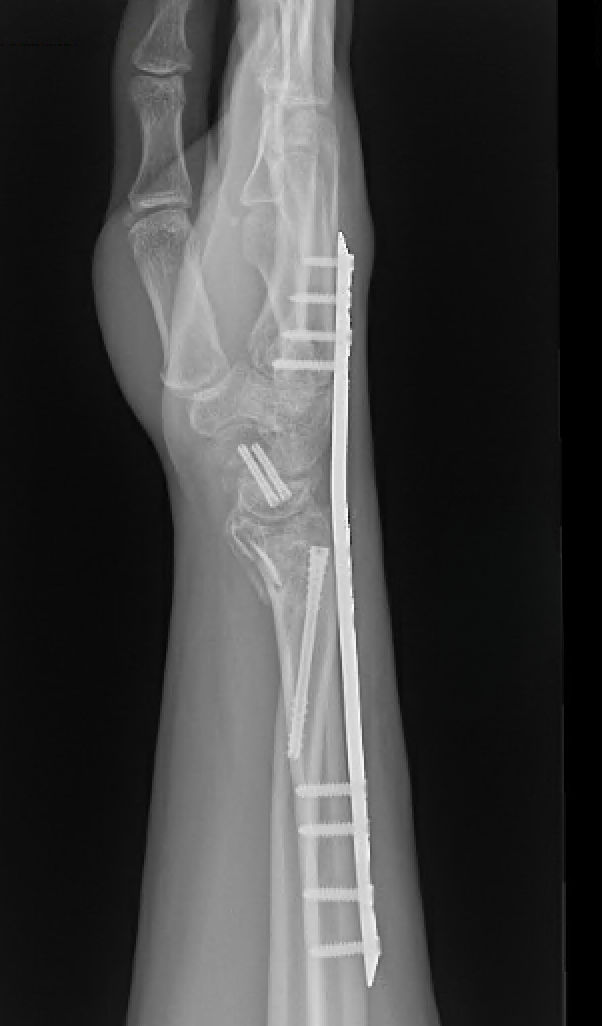 NX Nail fixation of distal ulna fracture in high energy wrist injury.