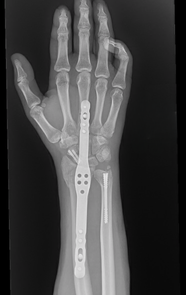 NX Nail fixation of distal ulna fracture in high energy wrist injury.