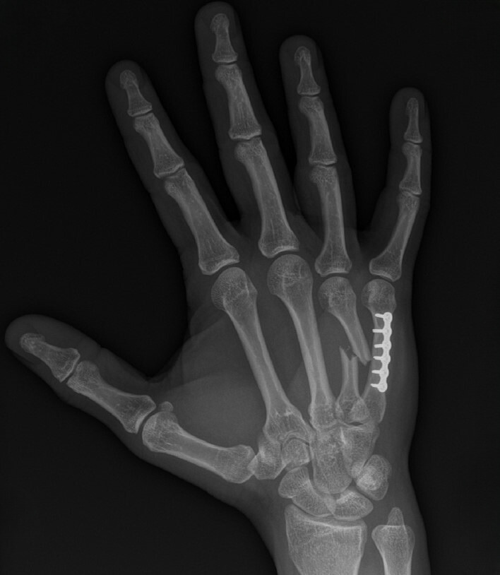 NX Nail for fixation of displaced 4th metacarpal shaft fracture.